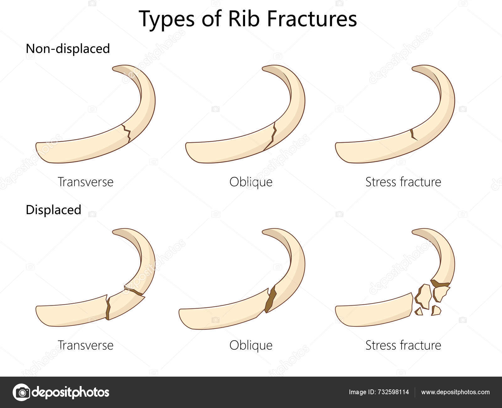 Types Rib Fractures Non Displaced Displaced Fractures Transverse ...