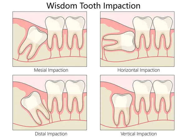 Wisdom tooth Stock Photos, Royalty Free Wisdom tooth Images | Depositphotos