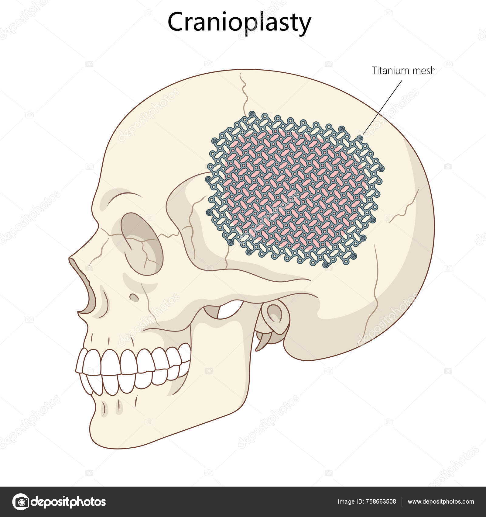 Skull Titanium Mesh Implant Used Cranioplasty Depicting Surgical Repair ...