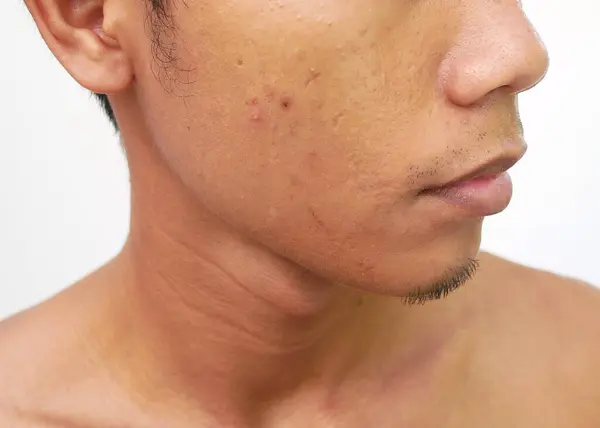 Face rash Stock Photos, Royalty Free Face rash Images | Depositphotos