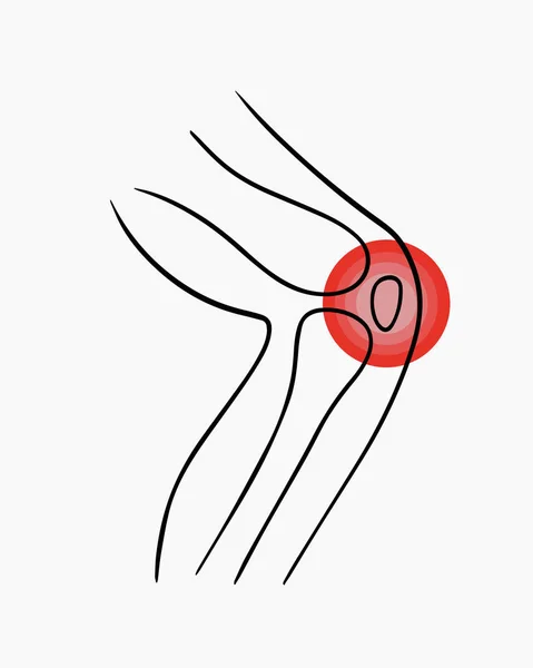 Bursitis imágenes de stock de arte vectorial | Depositphotos