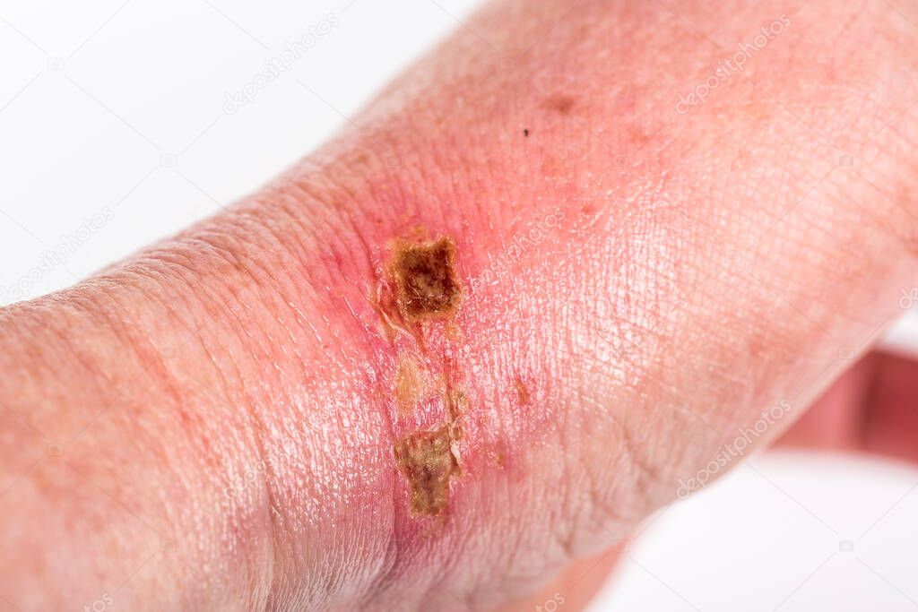 quemadura química en la piel de la muñeca con ácido hidróxido sódico ...