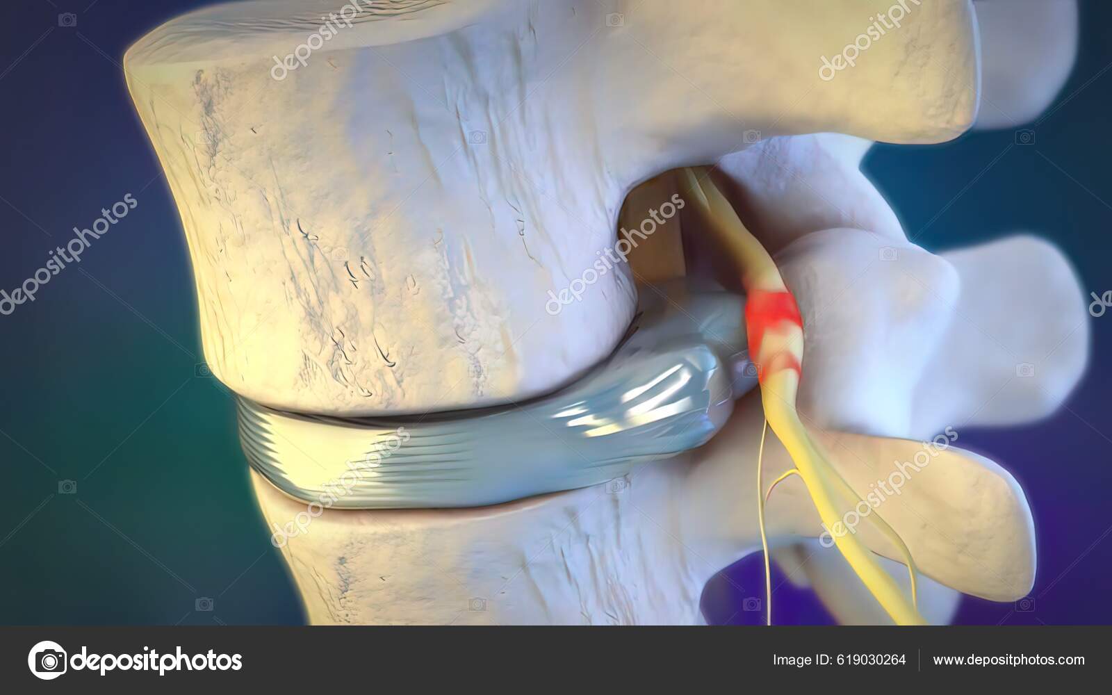 Slipped Disc Occurs Outer Ring Becomes Weak Torn Allows Inner Stock ...