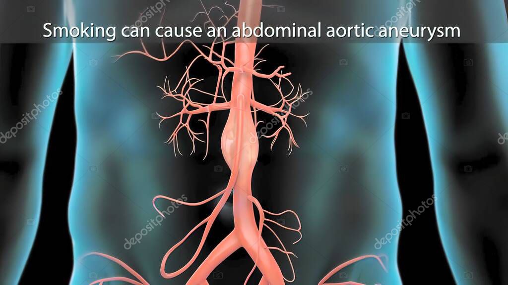 Fumar puede causar un aneurisma aórtico abdominal ilustración 3d 2022