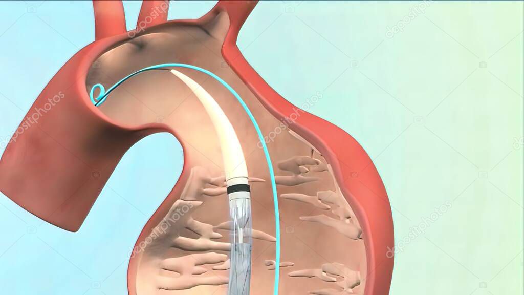 Implante de stent coronario. Procedimiento para el tratamiento de las ...