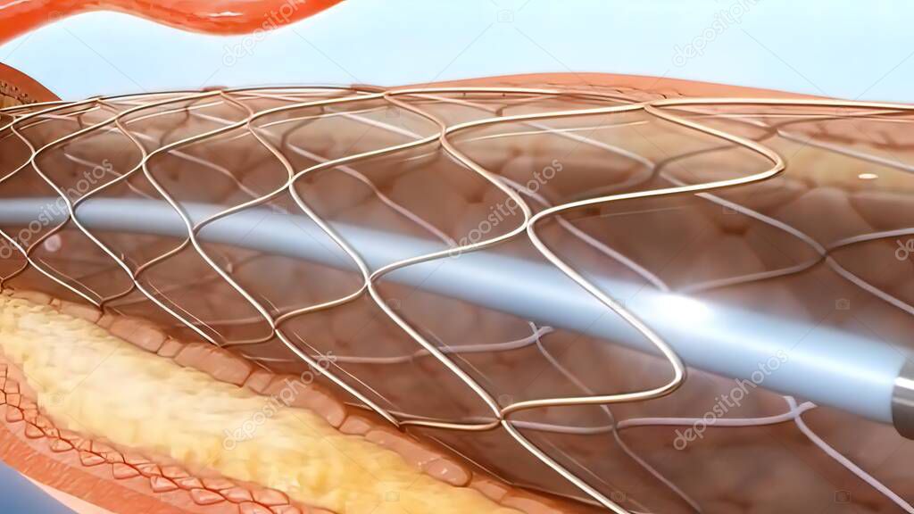 Cateterismo cardíaco, stent en el cuerpo Ilustración 3D 2023