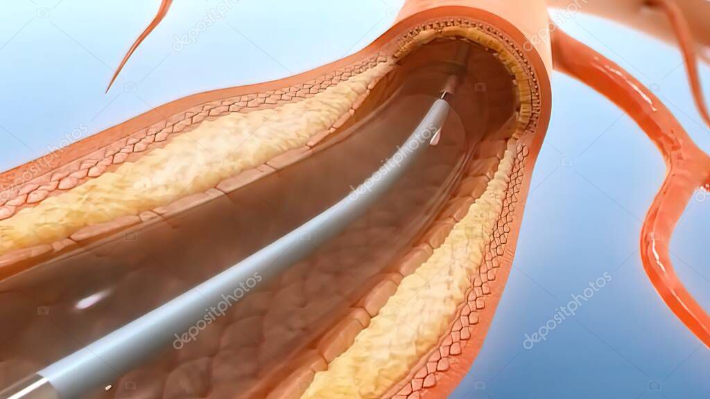 Cateterismo cardíaco, stent en el cuerpo Ilustración 3D 2023
