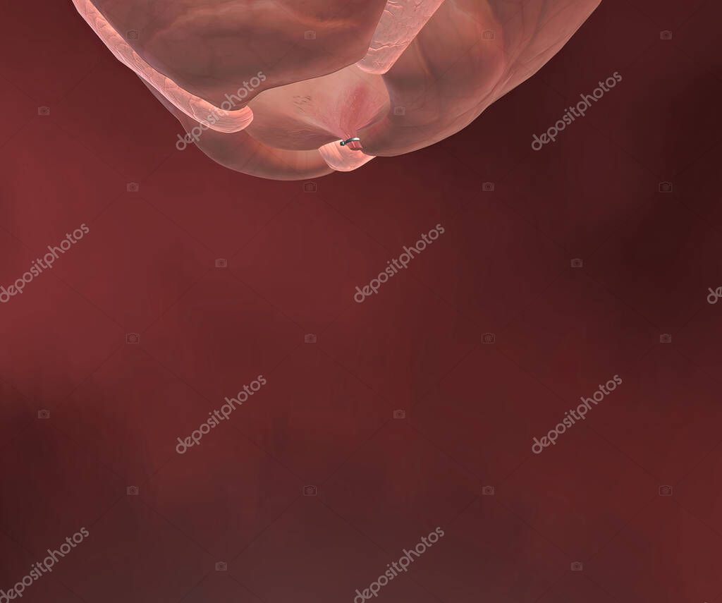 La apendicitis es una inflamación del apéndice, un saco en forma de ...