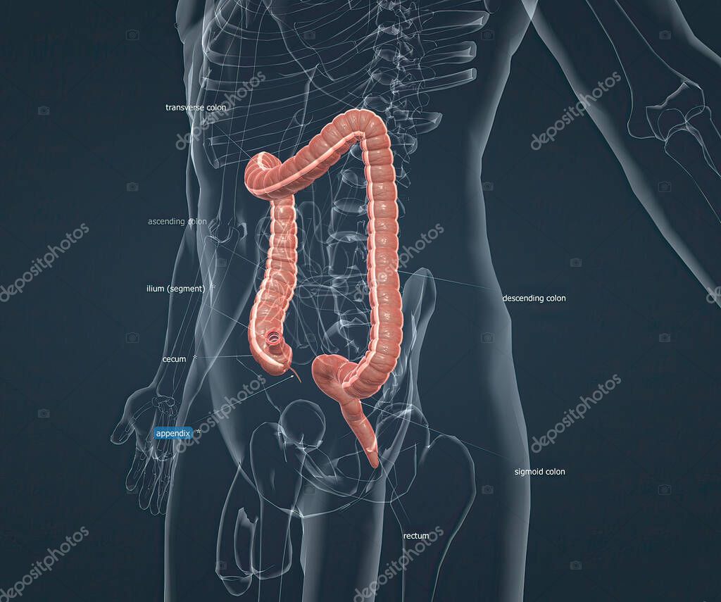 La apendicitis es una inflamación del apéndice, un saco en forma de ...
