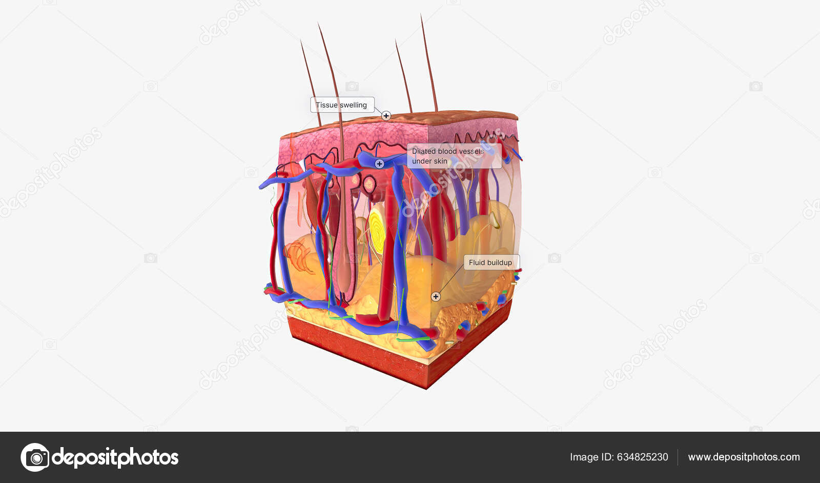 Angioedema Swelling Dermis Subcutaneous Tissue Anaphylaxis Histamine ...