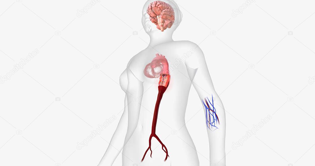 High volumes of immune cells infiltrate the inflamed aorta 3D rendering ... High volumes of immune cells infiltrate the inflamed aorta 3D rendering ...