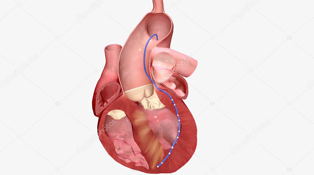 Alcohol causes enlarged heart muscle walls to shrink 3D rendering 2023