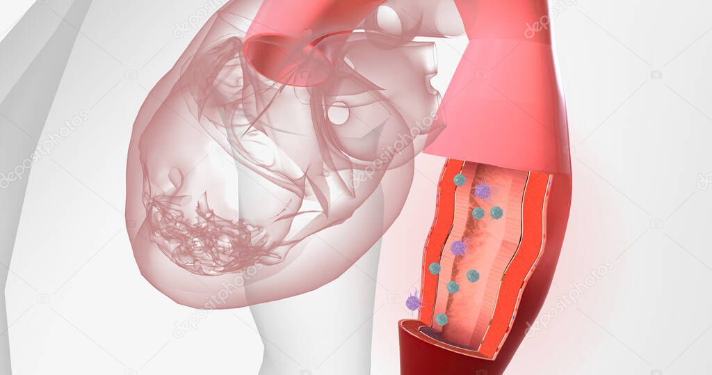High volumes of lymphocytes, macrophages, and other immune cells ... High volumes of lymphocytes, macrophages, and other immune cells ...