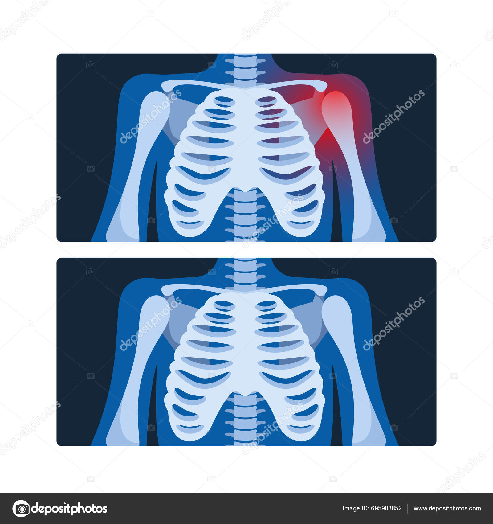 Radiografía Tórax Captura Imágenes Los Pulmones Estructuras ...