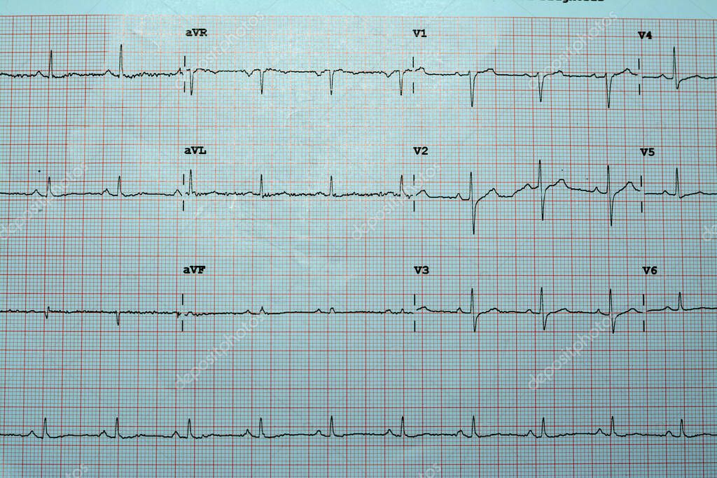 Un electrocardiograma ECG, un gráfico que dibuja la electricidad del ...