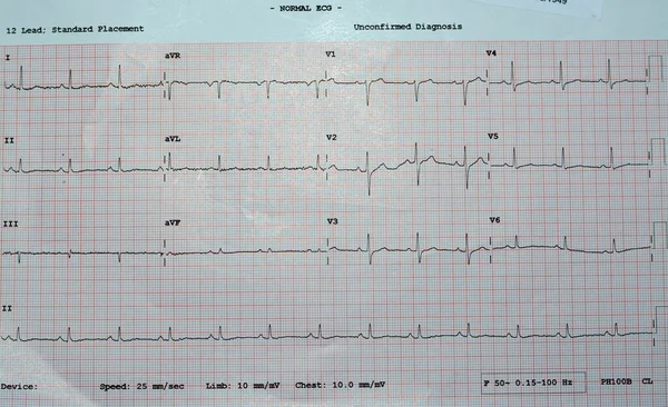 Ecg Electrocardiograph Paper Shows Normal Sinus Rhythm Nsr Frequent ...