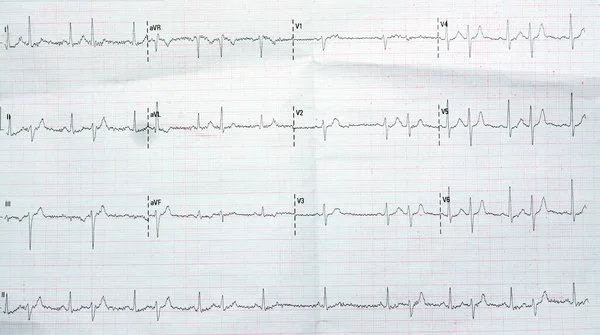 Ecg Electrocardiograph Paper Shows Normal Sinus Rhythm Nsr Frequent ...