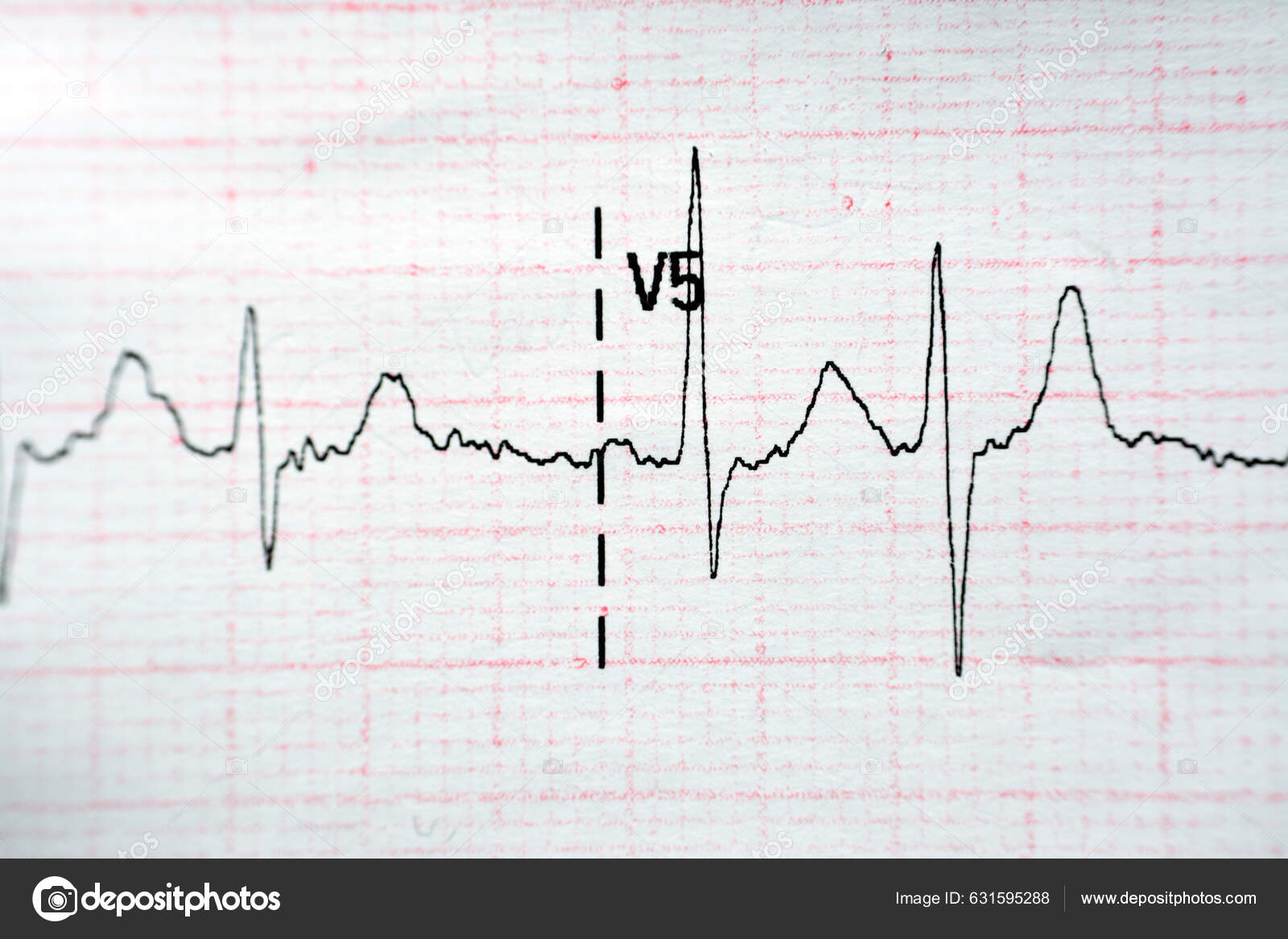 Ecg Electrocardiograph Paper Shows Normal Sinus Rhythm Nsr Frequent ...