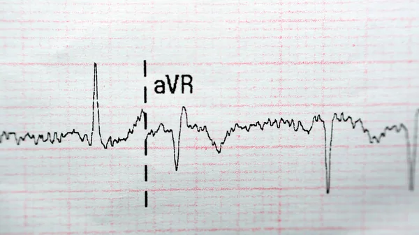 Ecg Electrocardiograph Paper Shows Normal Sinus Rhythm Nsr Frequent ...