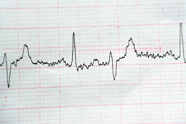 Ecg Electrocardiograph Paper Shows Normal Sinus Rhythm Nsr Frequent ...