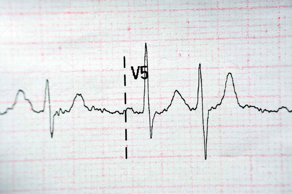 ECG ElectroCardioGraph paper that shows Normal Sinus Rhythm NSR with ...