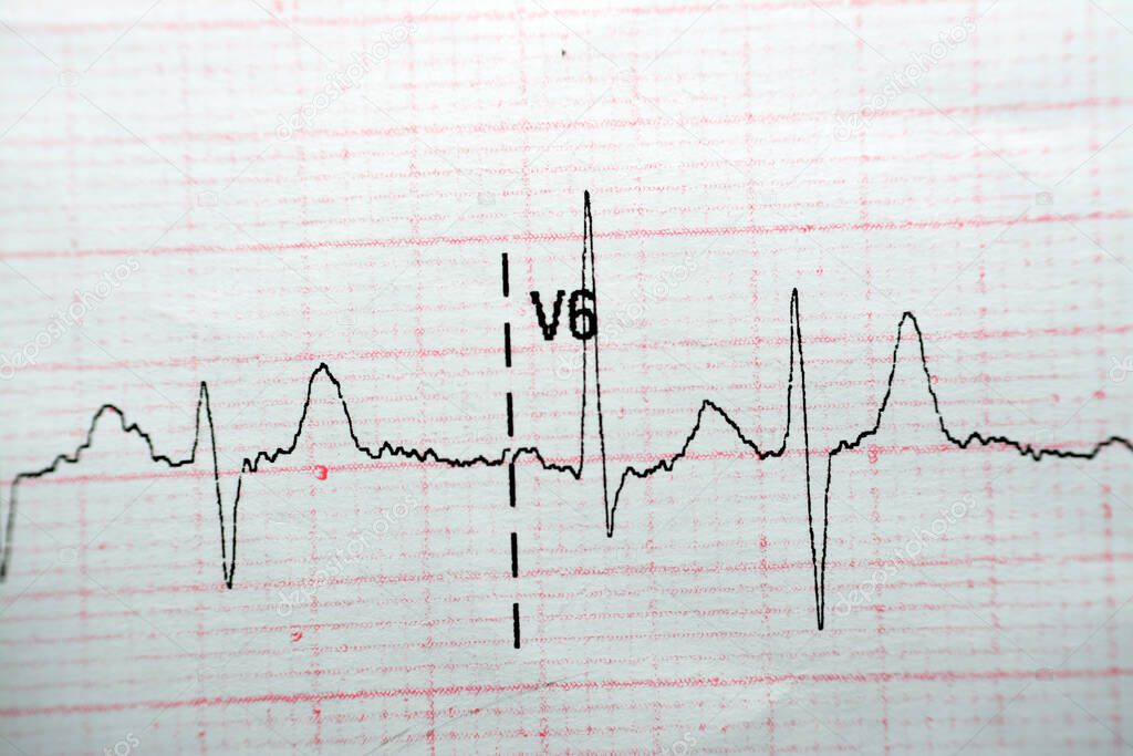 ECG ElectroCardioGraph paper that shows Normal Sinus Rhythm NSR with ...
