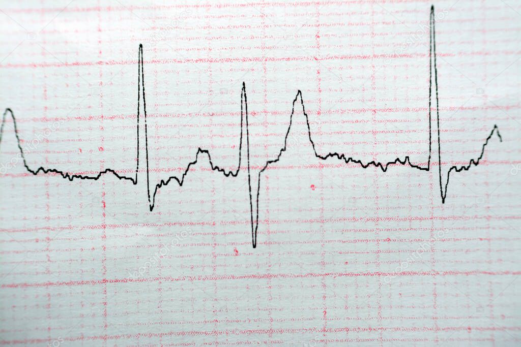 ECG ElectroCardioGraph paper that shows Normal Sinus Rhythm NSR with ...