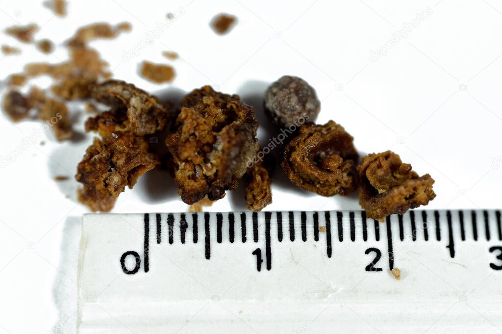 Nefrolitiasis, cálculos renales marrones irregulares (cálculo renal o ...