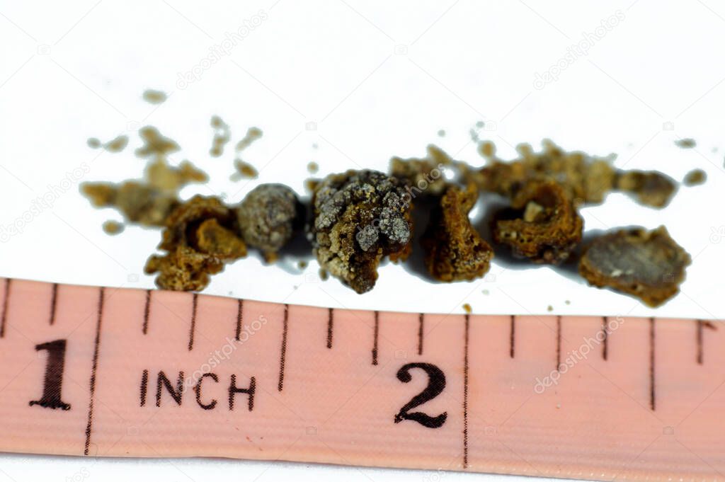 Nefrolitiasis, cálculos renales marrones irregulares (cálculo renal o ...