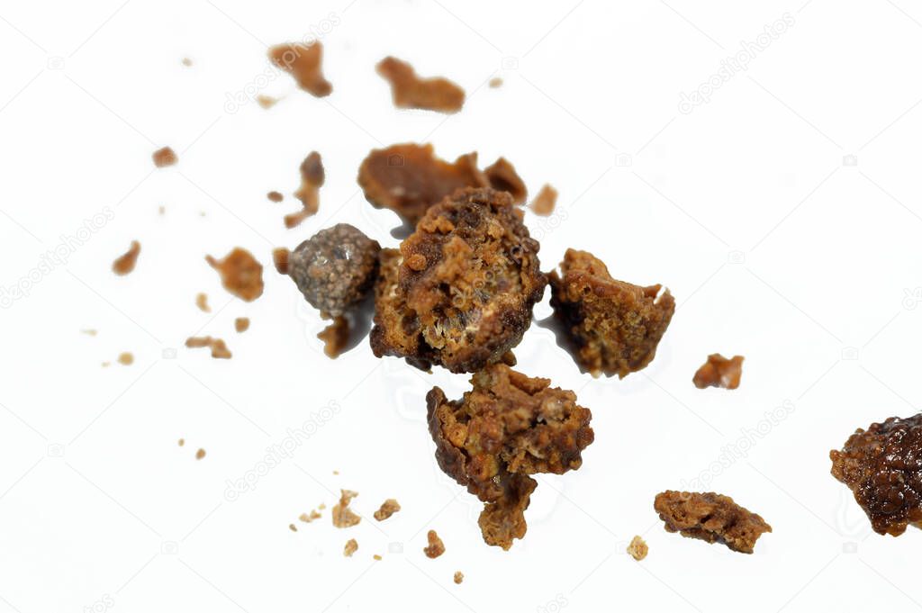 Nefrolitiasis, cálculos renales marrones irregulares (cálculo renal o ...