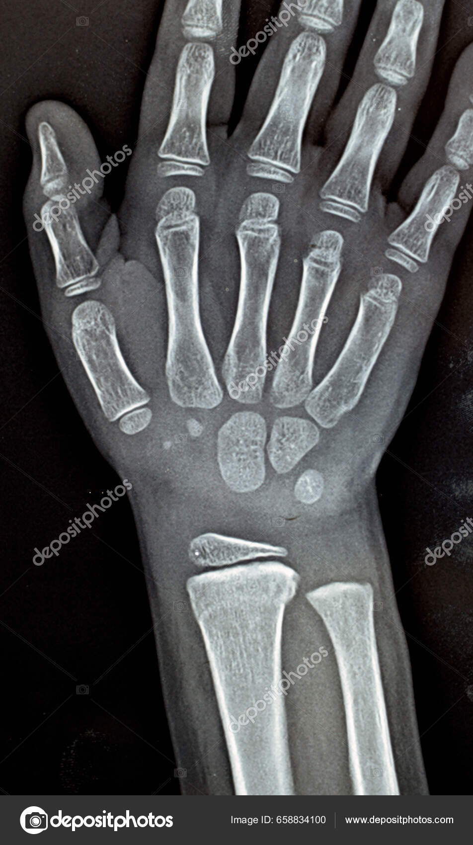 Wrist Joint X Ray