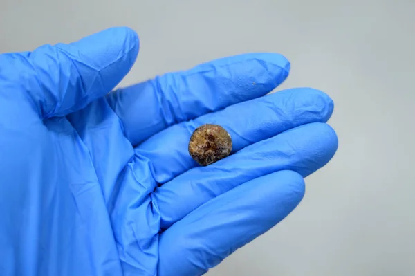 Cálculo biliar grande extirpado quirúrgicamente después de la ...