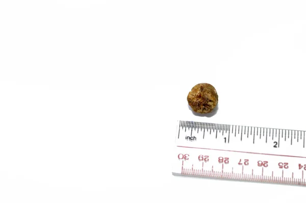 Cálculo biliar grande extirpado quirúrgicamente después de la ...