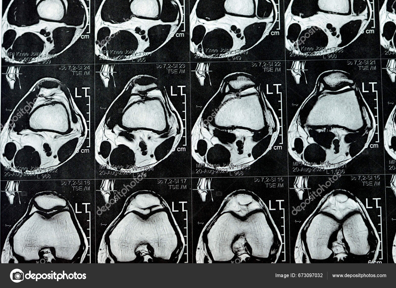 Mri Left Knee Joint Showing Minimal Joint Effusion Phmm Posterior Stock ...