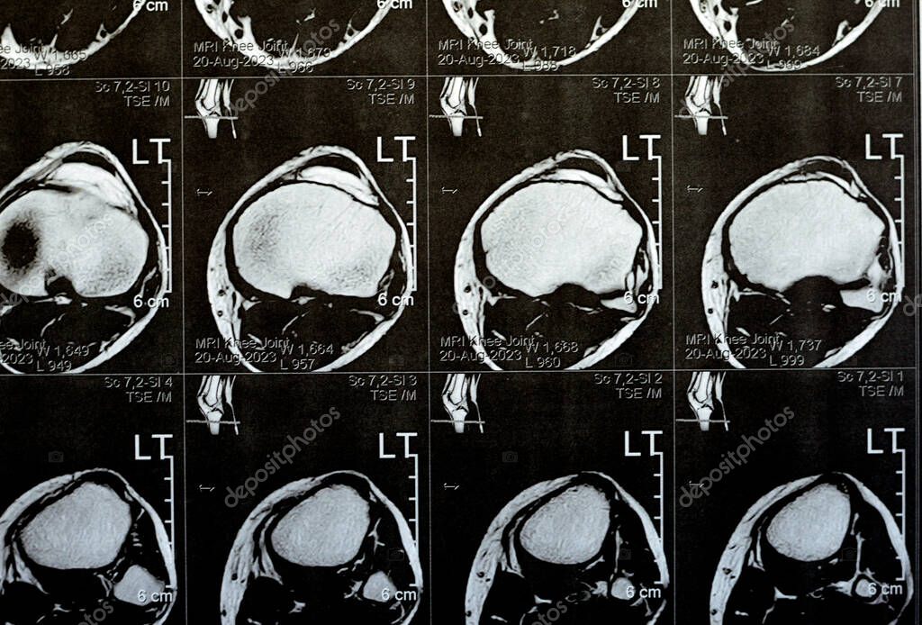 Resonancia magnética de la articulación de la rodilla izquierda que ...