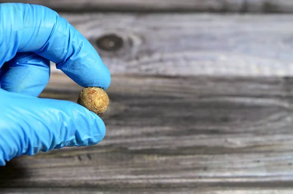 Cálculo biliar grande extirpado quirúrgicamente después de la ...