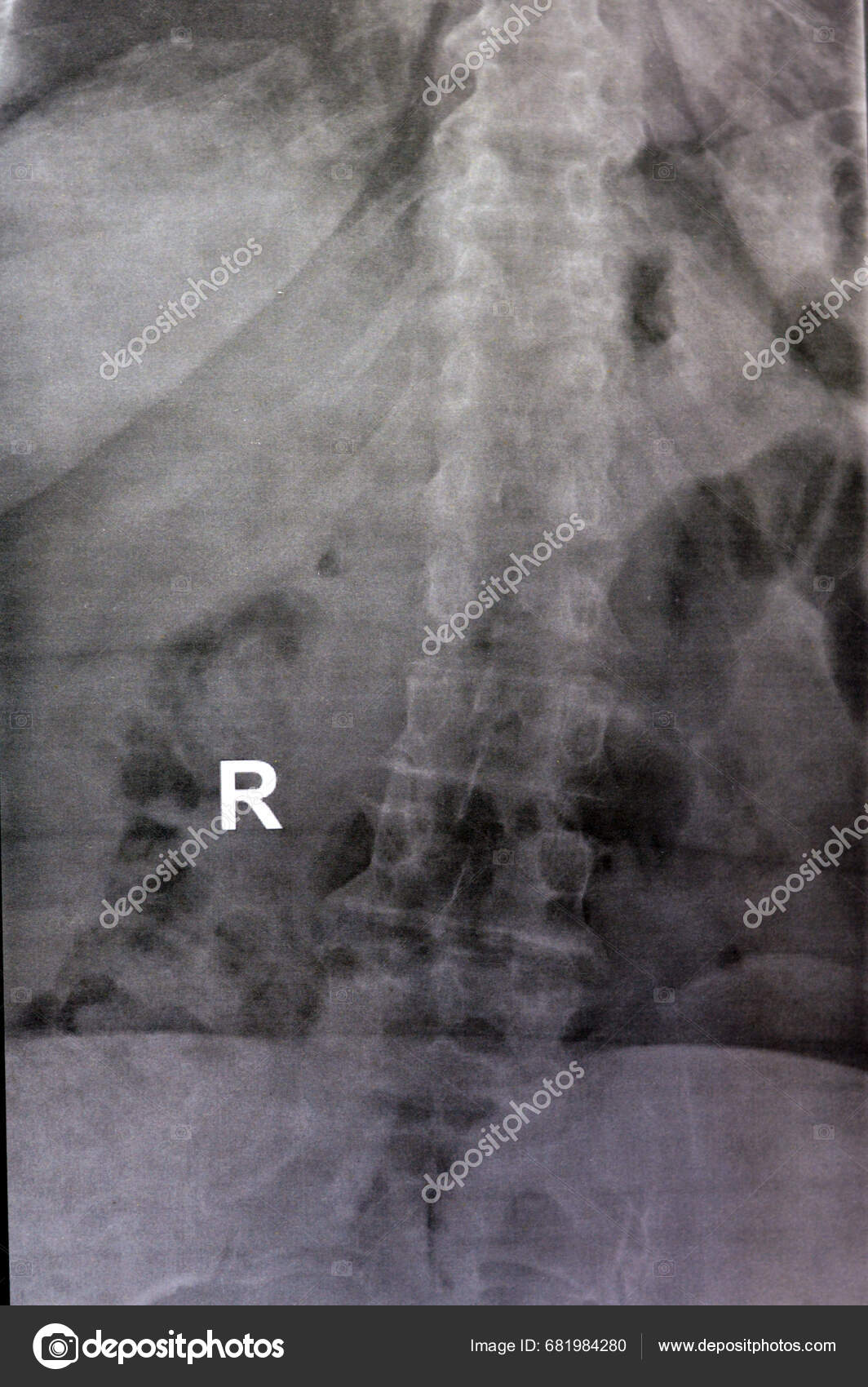 Plain Ray Dorsal Lumber Spine Reveals Spondylotic Changes Straightening ...