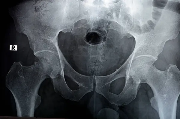 Las articulaciones de la cadera examen radiográfico digital revela un ...