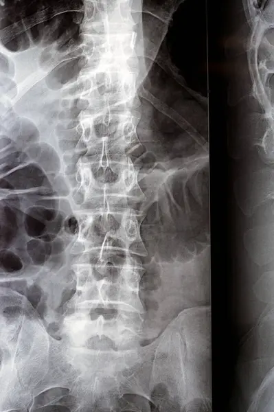 El examen radiográfico digital de la columna lumbosacra revela una ...