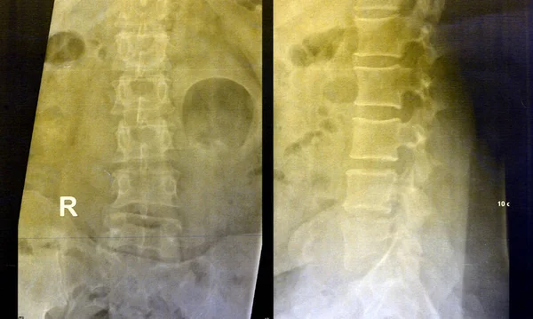 Plain Ray Dorsal Lumber Spine Reveals Spondylotic Changes Straightening ...