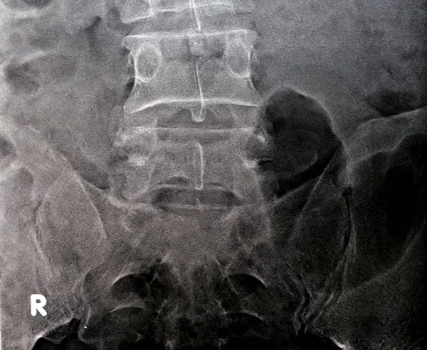Plain Ray Dorsal Lumber Spine Reveals Spondylotic Changes Straightening Dorsal Stock Photo by ...