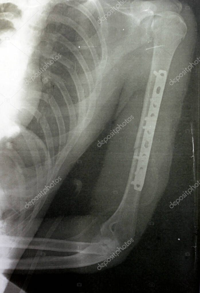 Radiografía simple que muestra fractura transversal del húmero ...