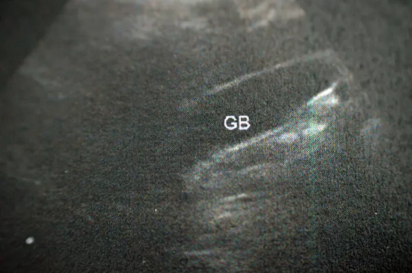 Vejiga biliar de tamaño medio y grosor normal de la pared, sin cálculos ...