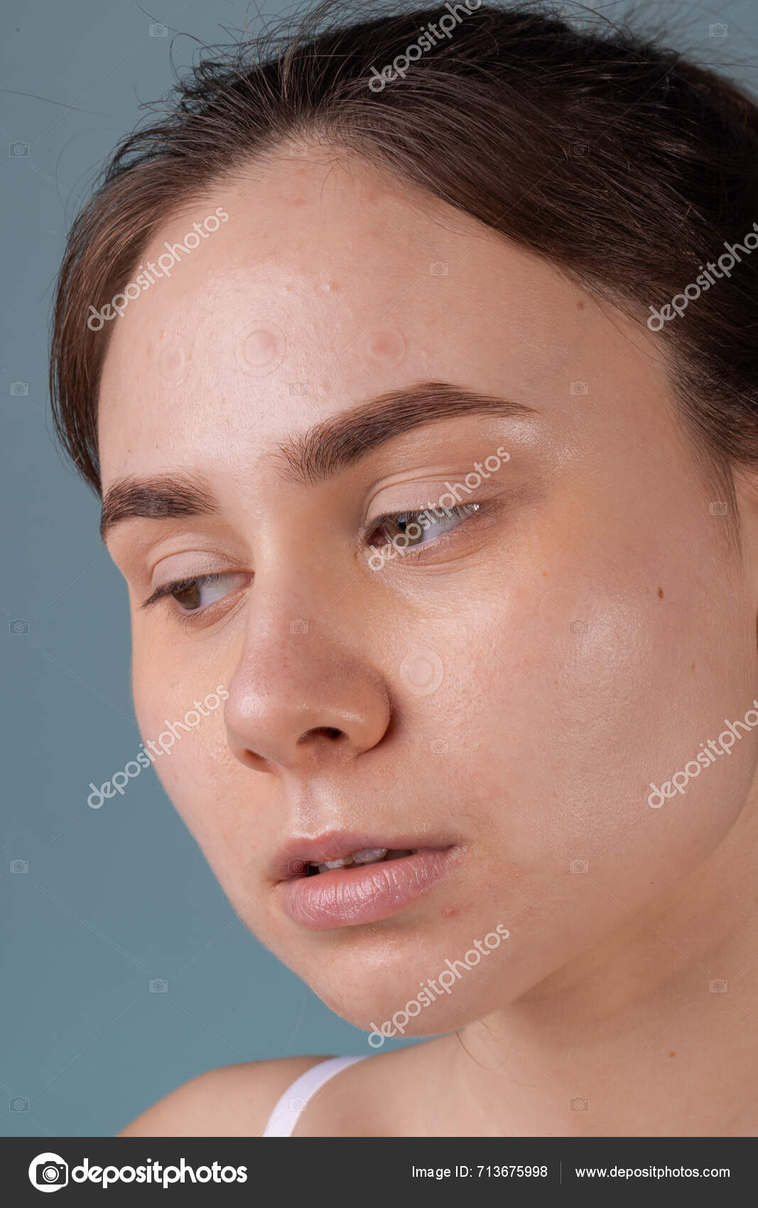 Girl Acne Stick Acne Patch Her Cheek Using Acne Patches — Stock Photo ...