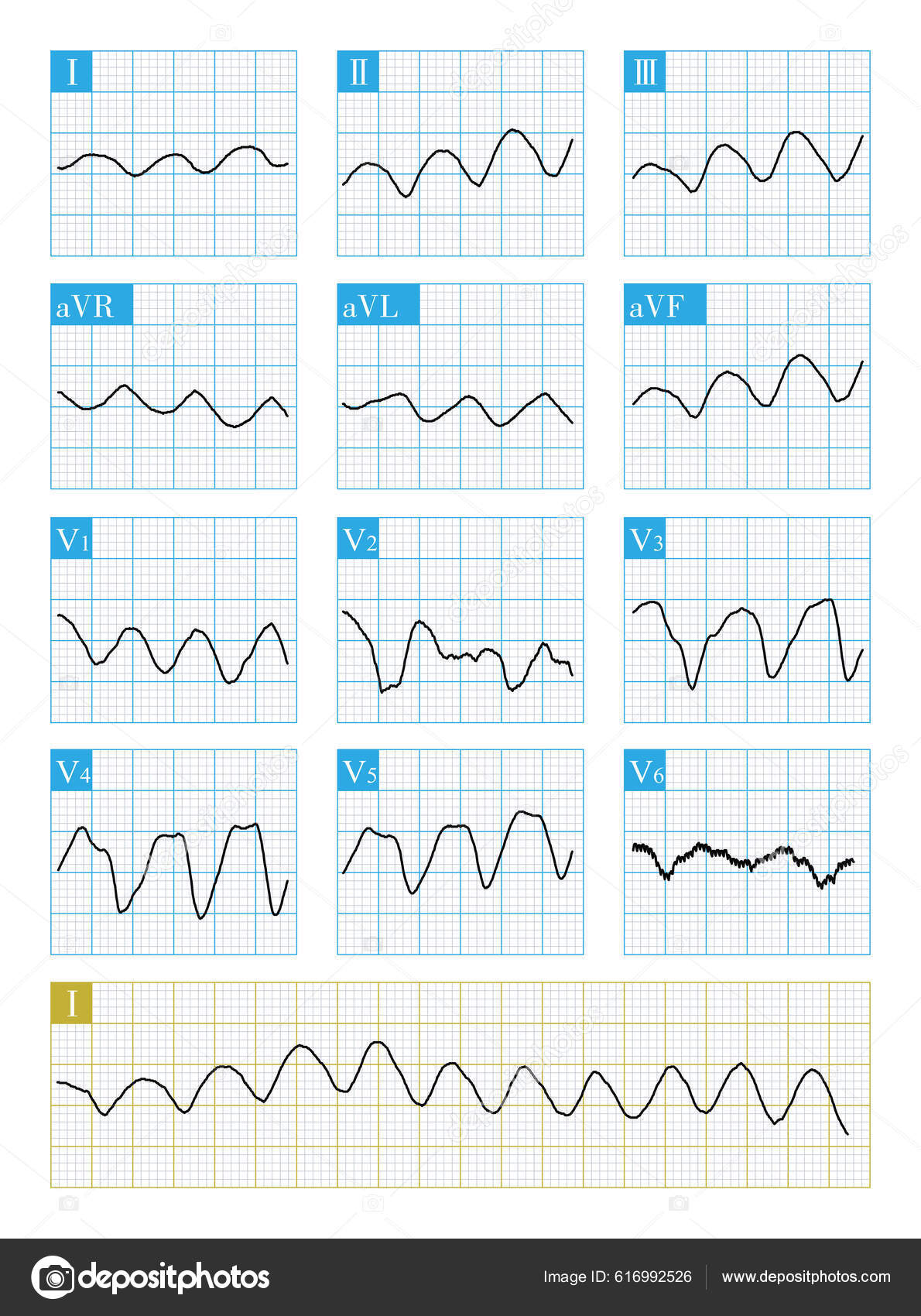 Flutterul Ventricular Este Aritmie Ventriculară Rapidă Fatală Unda Ecg ...