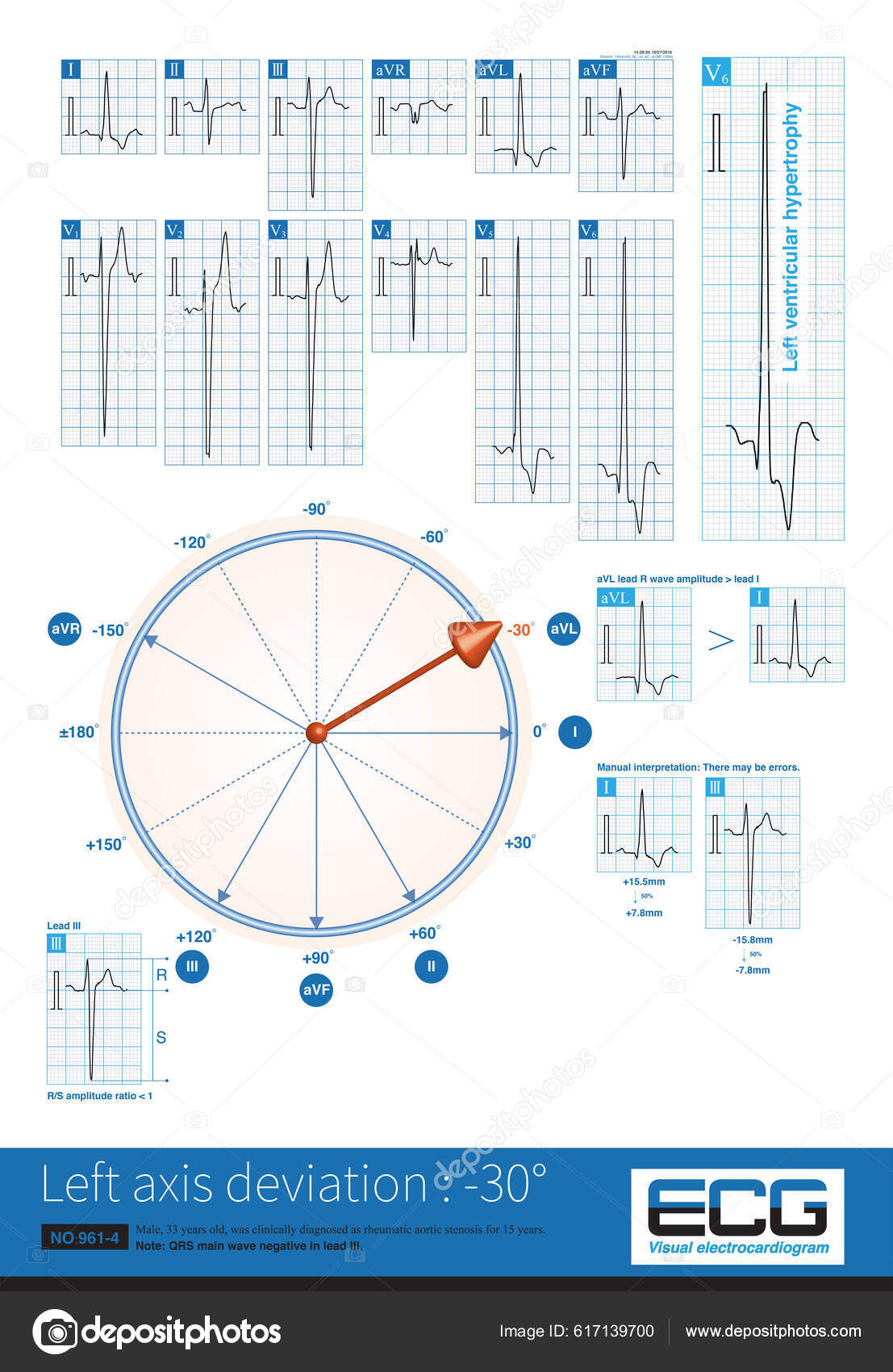 Left Ventricular Hypertrophy Common Cause Left Axis Deviation Frontal ...