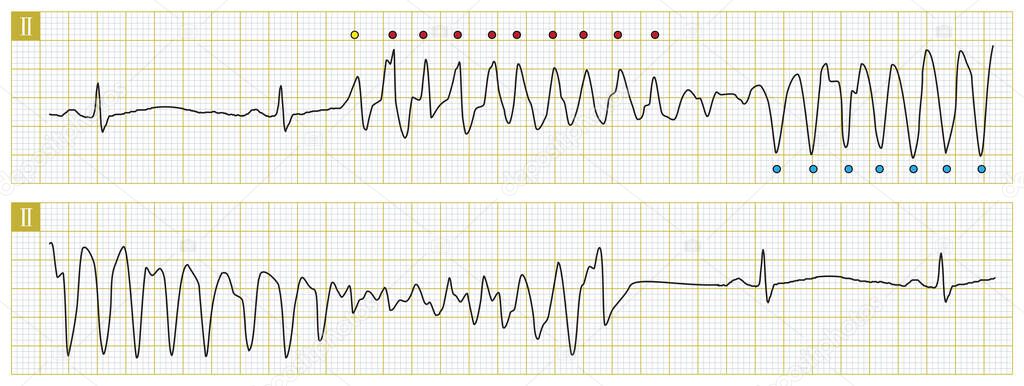 Torsades de pointes es una taquicardia ventricular polimórfica que ...