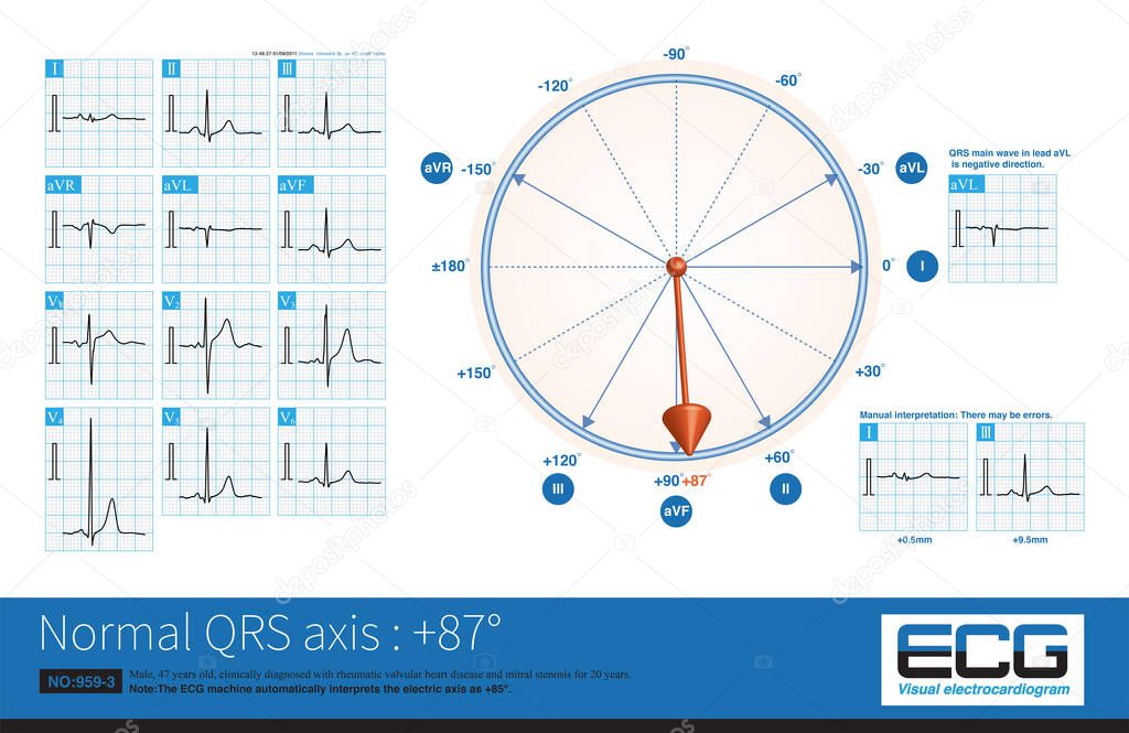 Cuando el eje QRS frontal se encuentra en + 87, se encuentra en el lado negativo del eje de ...