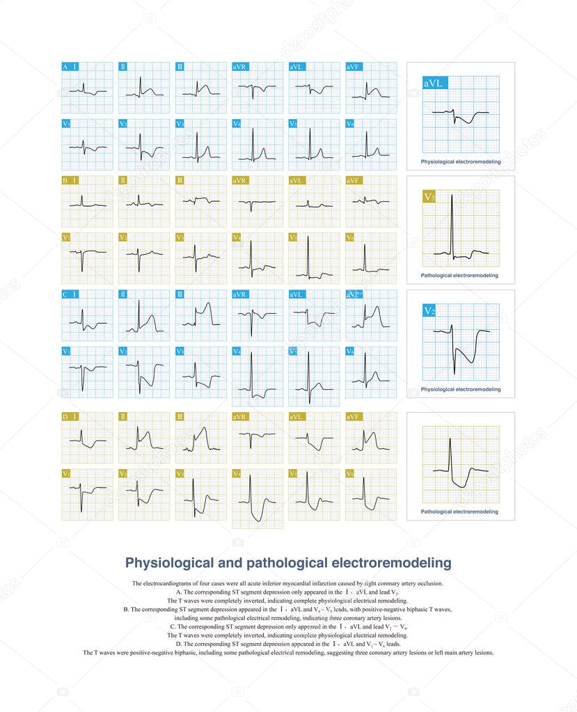 En el infarto agudo de miocardio inferior, la depresión ...