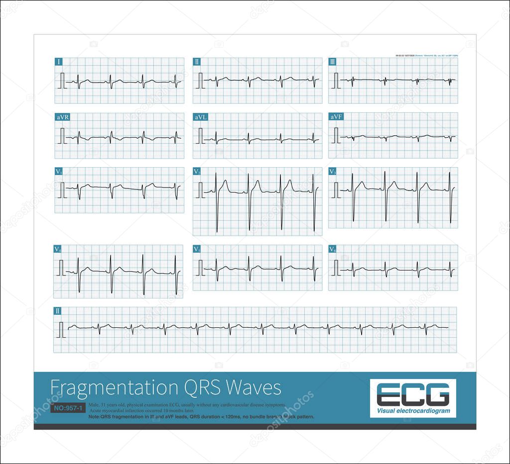 Fragmentación La onda QRS se refiere a la onda trifásica o multifásica ...